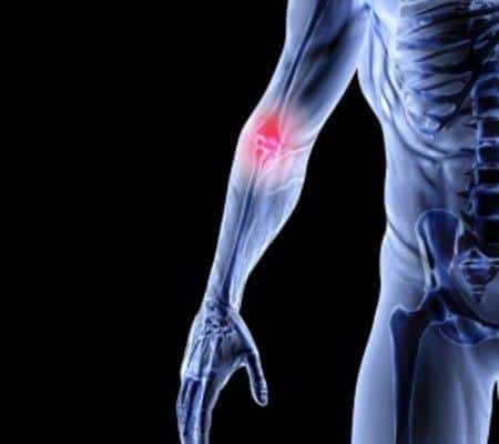 Epitrocleitis: Síntomas y tratamiento del codo de tenista